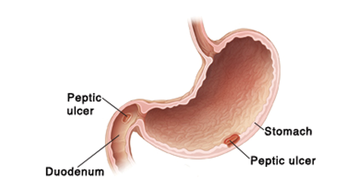 UNDERSTANDING PEPTIC ULCERS AND THE ROLE OF MYSTOMATE4. – Egflorence